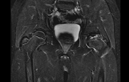 MR Pediatric Hip Perthes WWO Protocol | OHSU